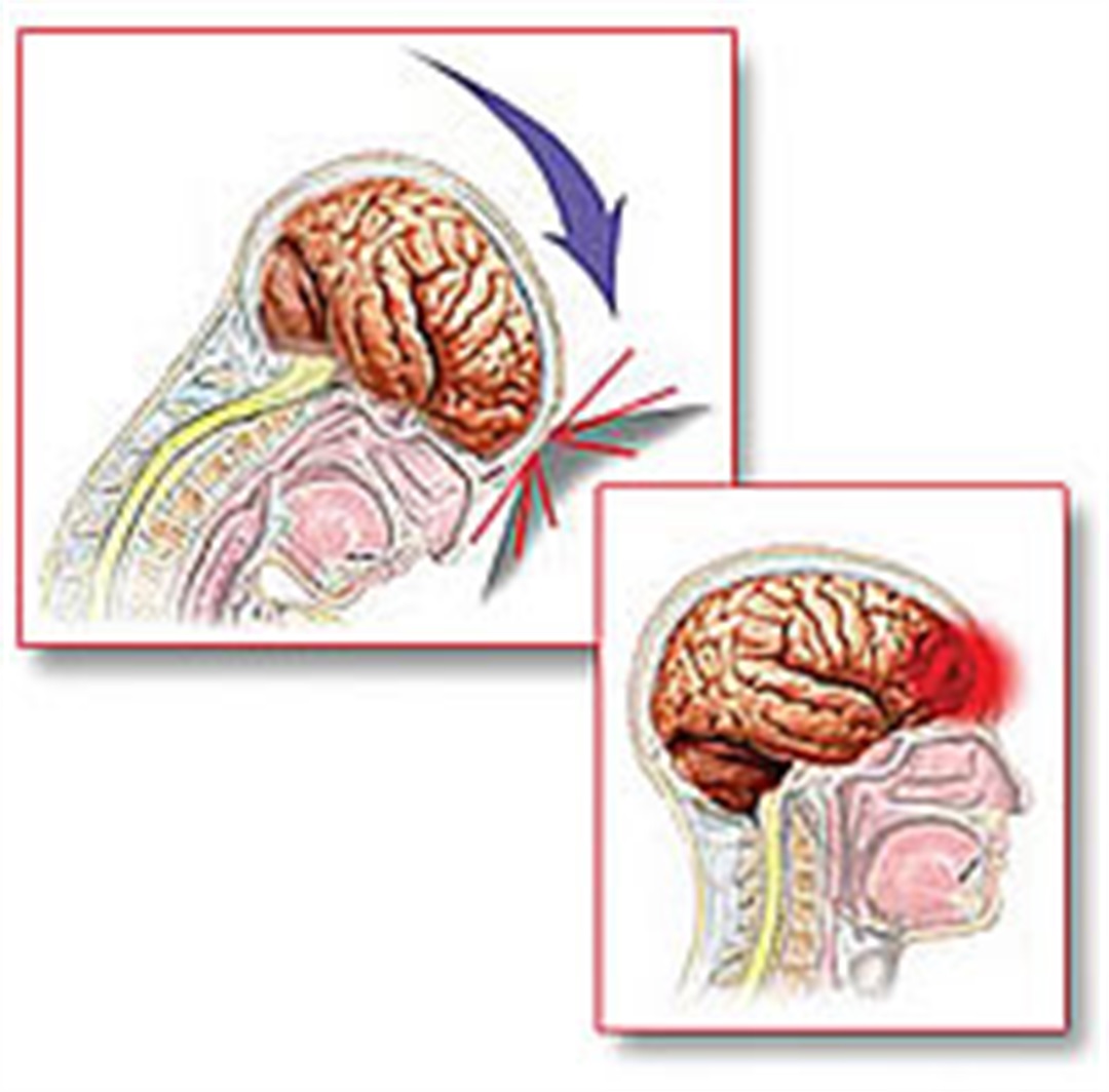 Second Impact Syndrome - El Dorado County